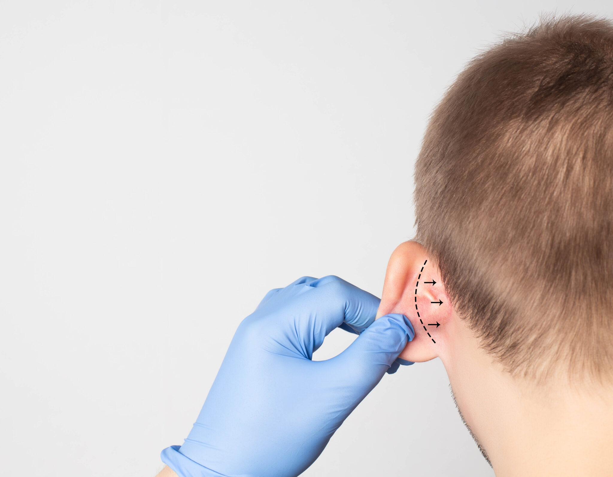 Otoplasty (Ear Surgery) – Dr. Daria Hamrah
